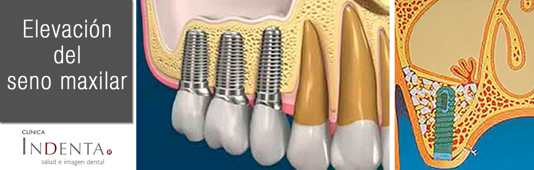 Elevación del seno maxilar Alicante| Clínica Dental Alicante